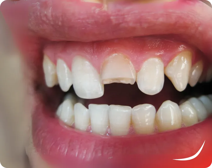 Broken and Chipped Tooth Treatment Aspley, North Brisbane